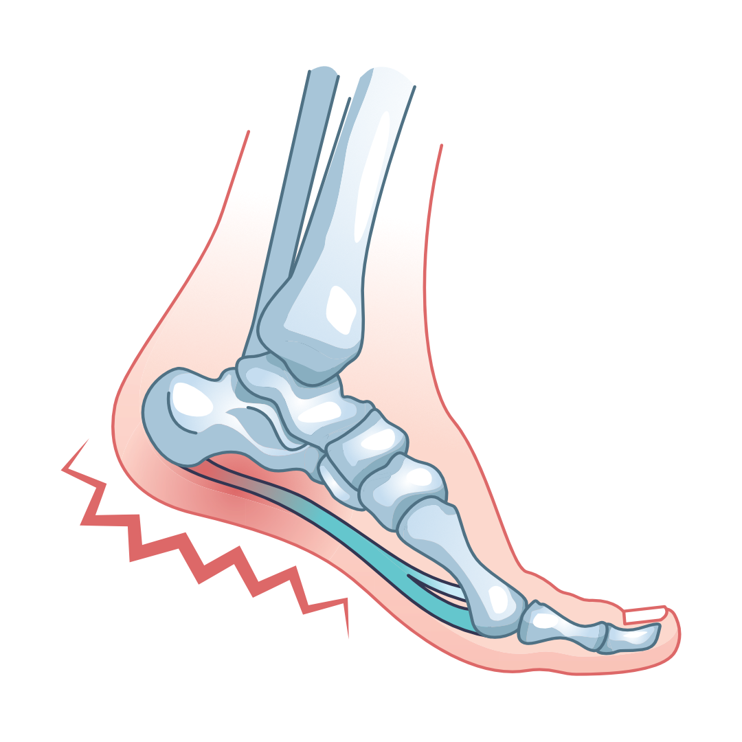 Hielspoor symptomen | Wat te doen bij PIJN.nl