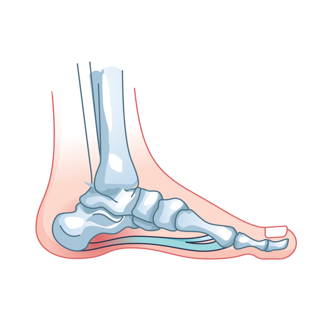 Hielspoor behandeling | Wat te doen bij PIJN.nl