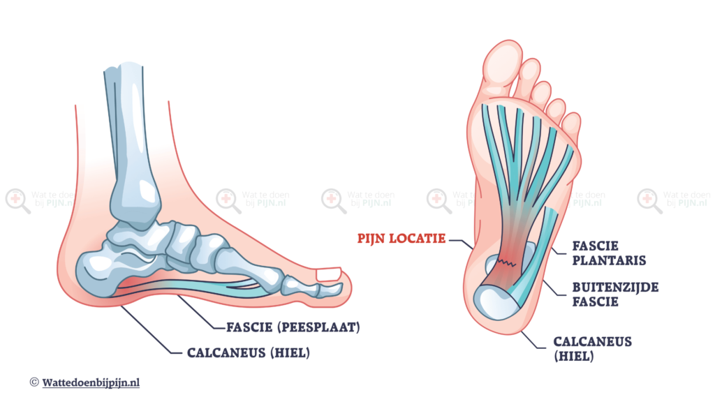 Hielspoor oorzaak | Wat te doen bij PIJN.nl