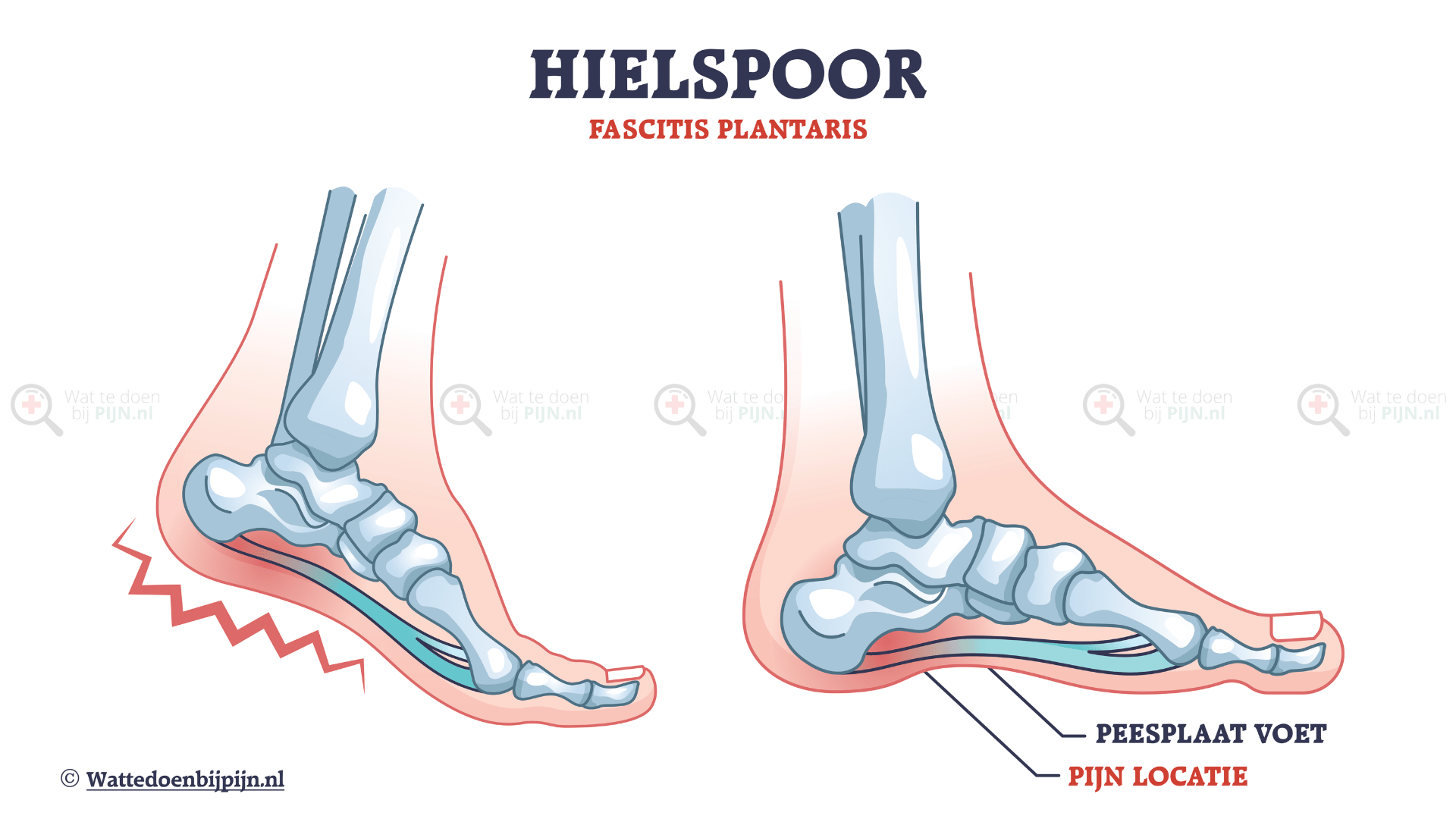 Hielspoor symptomen | Wat te doen bij PIJN.nl