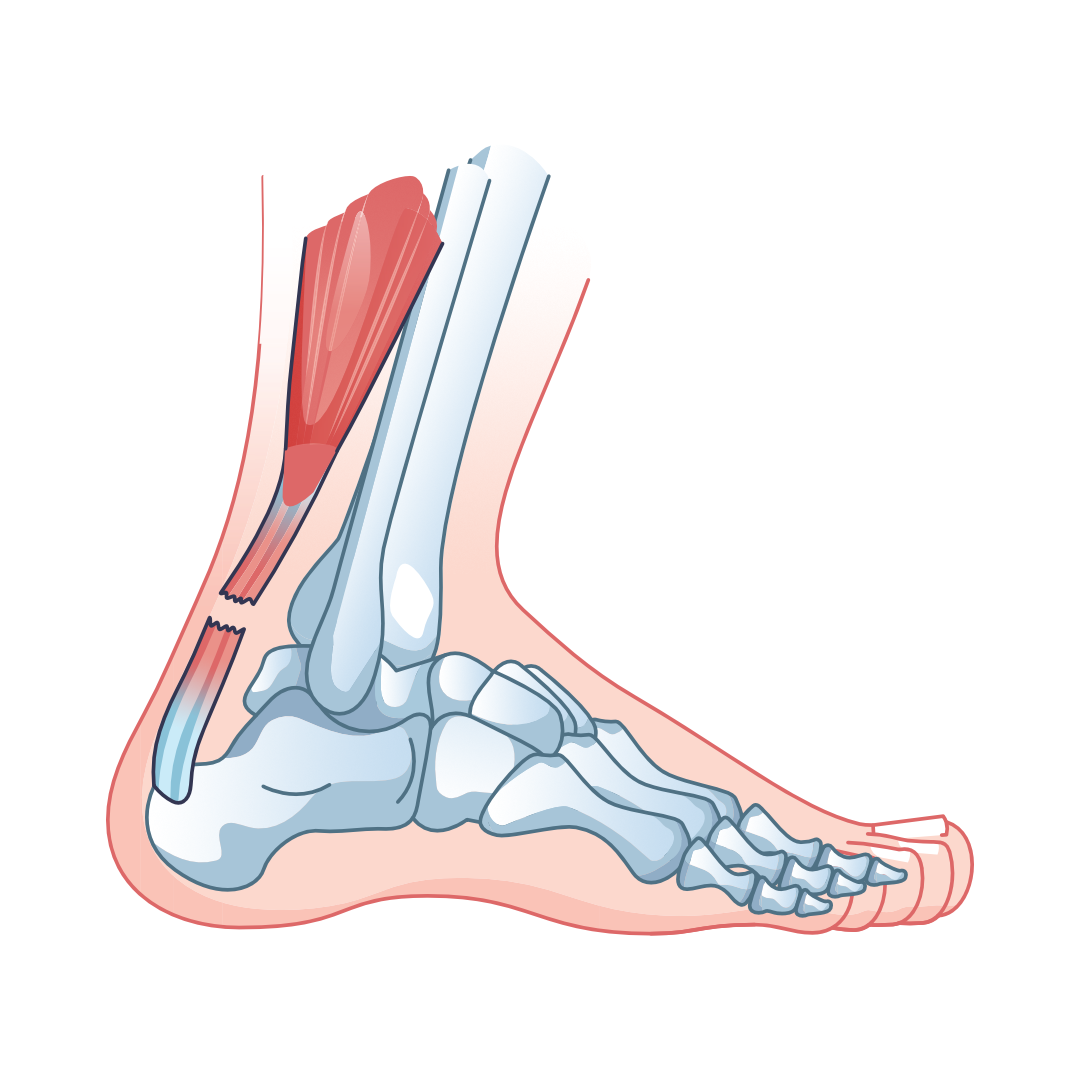 Achillespees afgescheurd revalidatie | Wat te doen bij PIJN.nl